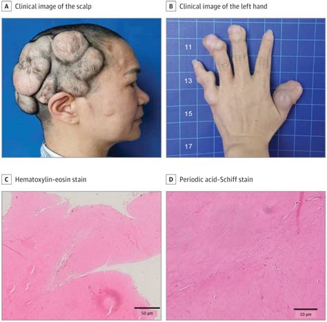 Jama Dermatology On Linkedin Multiple Painless Scalp Nodules