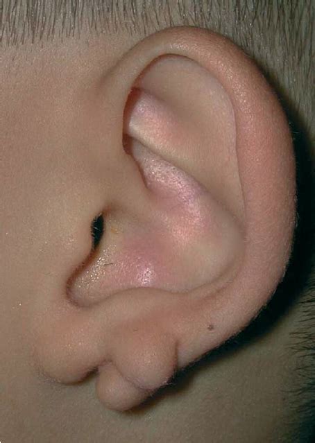 Cleft Ear Cleft Lip Stephan Bessler Nasal Surgery Clinic Zurich