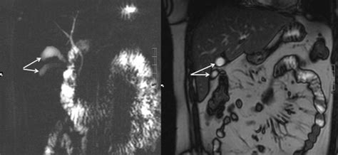 Mrcp Showing Duplex Gallbladder Shown By Arrows Download
