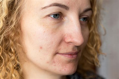 문제가있는 젊은 아름다운 여성의 초상화 젊은 여성의 얼굴에 여드름 흉터와 붉은 부패 여드름 후 스킨 케어 컨셉 30 39세에 대한 스톡 사진 및 기타 이미지 Istock