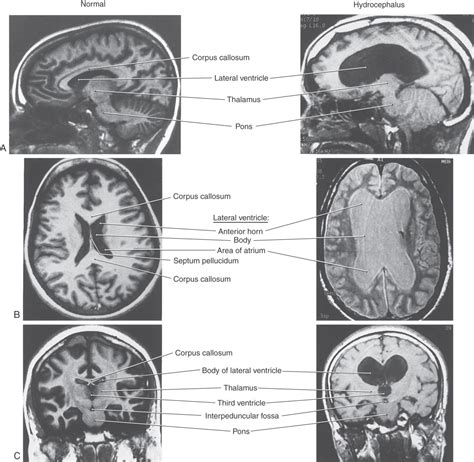 The Ventricles Choroid Plexus And Cerebrospinal Fluid Clinical Gate