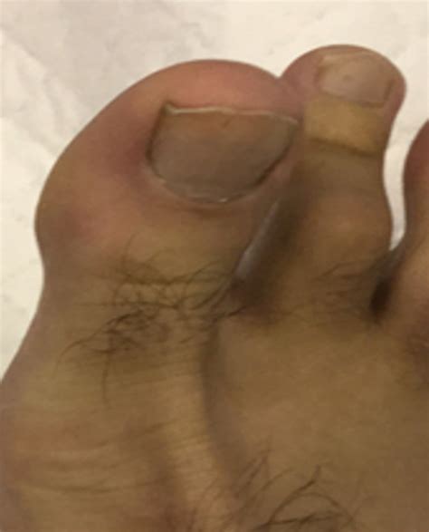 Preoperative Photograph Right Second Toe With A Flexion Deformity Of