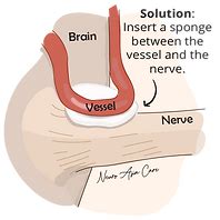 Trigeminal Neuralgia Singapore Treatment Guide 2024