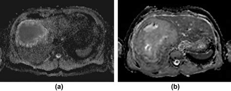 Hepatic Alveolar Hydatid Disease Echinococcus Multilocularis A Mimic Of Liver Malignancy A
