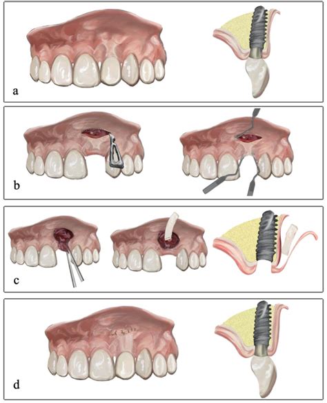 Schematic Diagrams Showing Frontal And Sagittal Sections Of The Apical