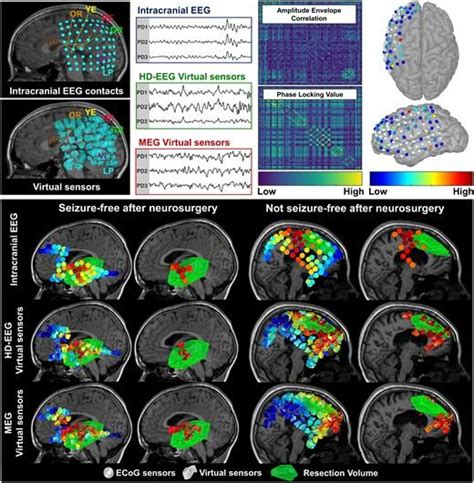 Megin On Linkedin Non Invasive Mapping Of Epileptogenic Networks Predicts Surgical Outcome