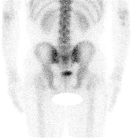 A 99mtc Mdp Bone Scan Revealed That The Bone Metastases Were Absorbed Download Scientific Diagram