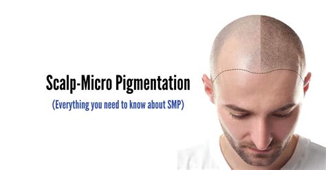 All You Need To Know About Scalp Micro Pigmentation Flow Pmu All You Need To Know About Scalp Micro Pigmentation Flow Pmu