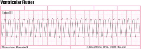 Ecg Educator Blog Ventricular Flutter