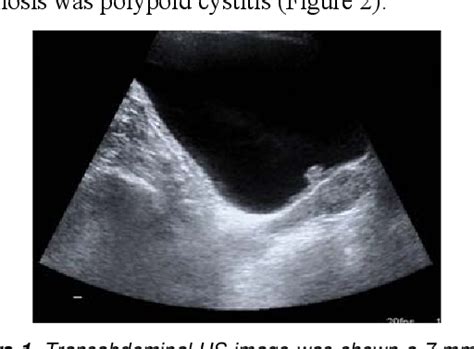 Figure 2 From A Case Of Polypoid Cystitis Mimicking Bladder Tumor In