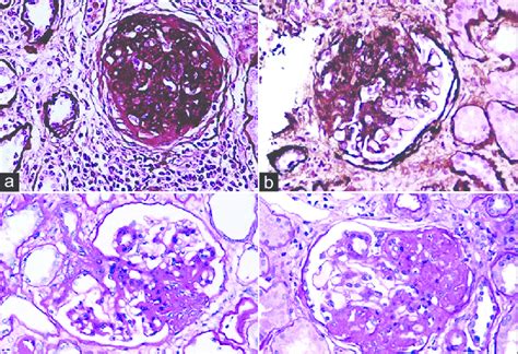 Global Glomerulosclerosis
