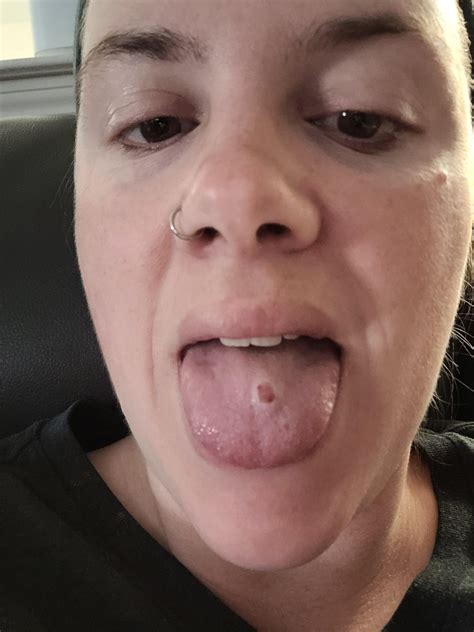 Pyogenic Granuloma From Pregnancy Or Something Else Raskdentists