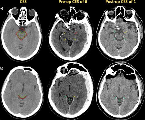 ct scans display sections at the level of perimesencephalic upper row
