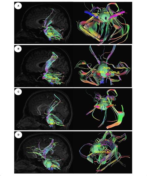 Diffusion Mri Fiber Tracking Connecting Pons With The Gustatory Download Scientific Diagram