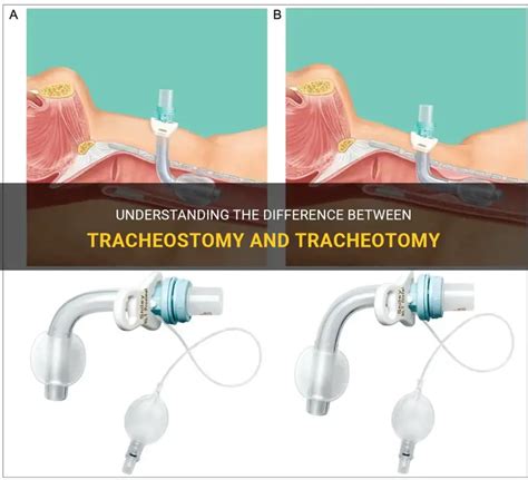 Understanding The Difference Between Tracheostomy And Tracheotomy Medshun