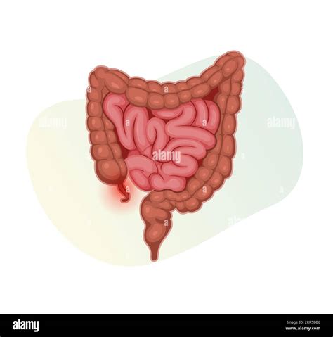 Appendicitis Inflamed Appendix Stock Illustration As Eps 10 File