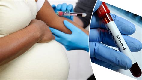 Texas City Reports Syphilis Outbreak Amid Limited Supply Of