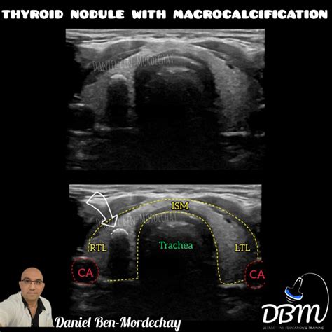 Understanding Thyroid Nodules With Calcification On Ultrasound Daniel Ben Mordechay Posted On