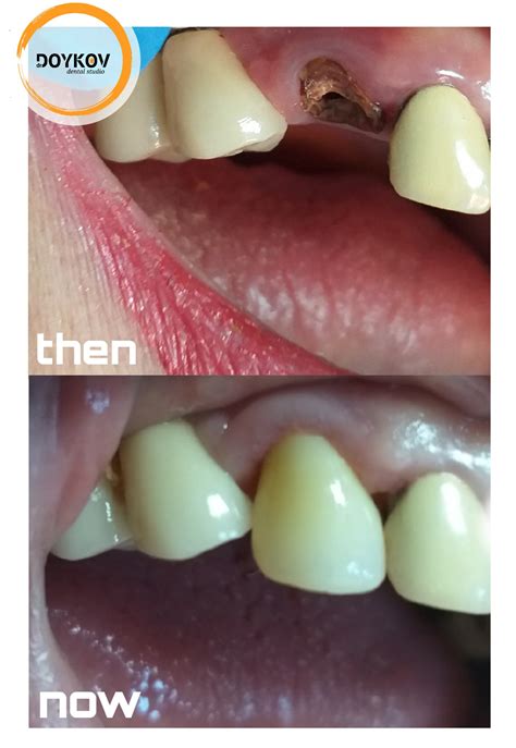 Дентално студио д р Валентин Дойков Случай на възстановяване на изцяло разрушен зъб с