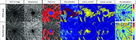 Examples Of Quantification Of Macular Oct A Metrics By Our Customised Download Scientific