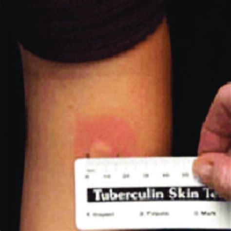 Intradermal Ppd Injection Download Scientific Diagram