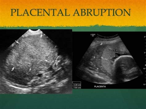Radiological Evaluation Of The Placenta