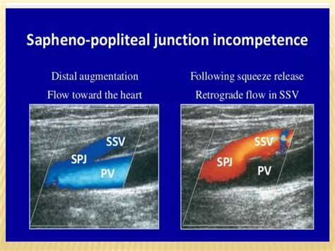 Venous Doppler Lower Limb Dr Mukesh Tilgam Pptx