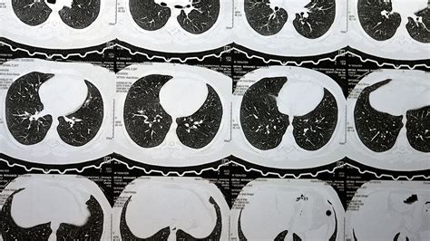 Progressing Interstitial Lung Abnormalities Linked To Respiratory