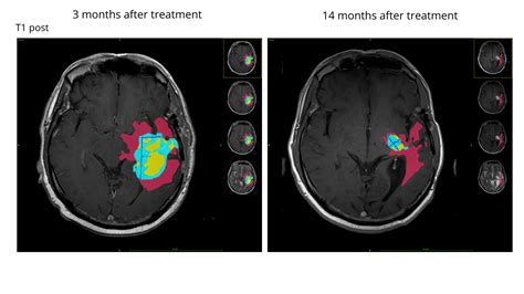 Automatic Brain Tumor Segmentation