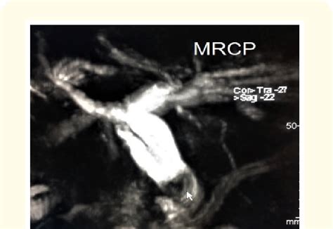 Mrcp Revealing Sickle Cell Cholangiopathy With Cbd Stone Arrow E