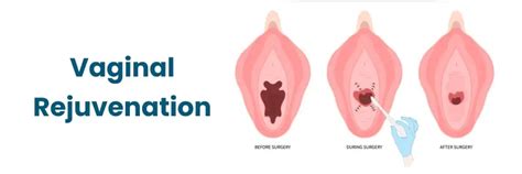 Vaginal Rejuvenation Benefits Procedure And Risks
