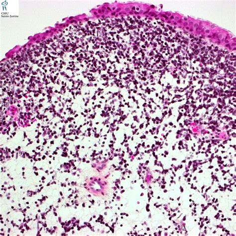 Rhinopharyngeal Embryonal Rhabdomyosarcoma Human Pathology