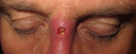 Worst Spider Bites In The World Identifying 11 Common Insect Bites