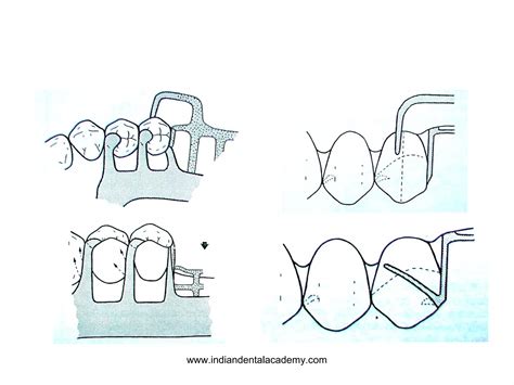 Mandibular Class I Situationendodontic Courses Ppt