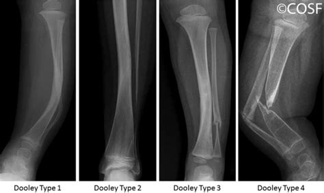 Management Of Congenital Pseudoarthrosis Of The Tibia And Fibula Pmc