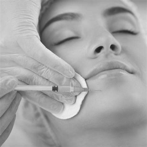 Subcision Retroderm Medical Aesthetics