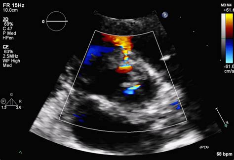 Ventricular Septal Defect Vsd Cardio Guide