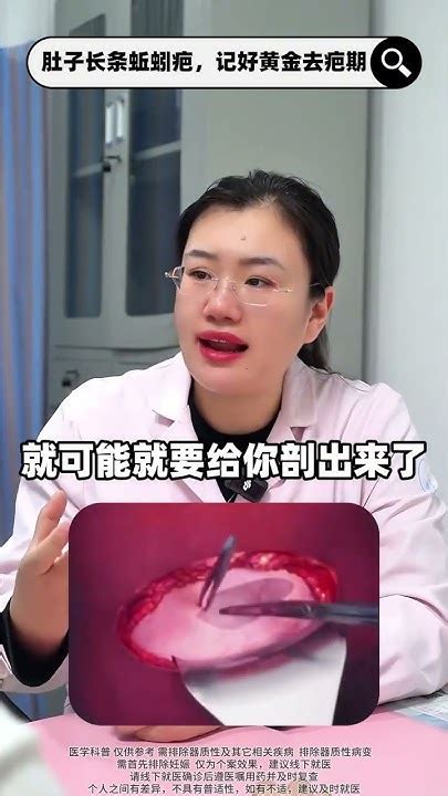 【养生堂】肚子长条蚯蚓疤，记好黄金去疤期 涨知识 硬核健康科普行动 健康科普 女性 蚯蚓疤【1分钟养生】性行为 Sex 生殖
