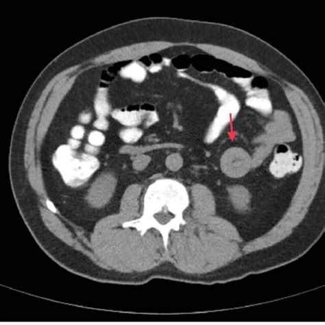 Ct Scan Demonstrating The Classical Target Sign Morphology Of Download Scientific Diagram