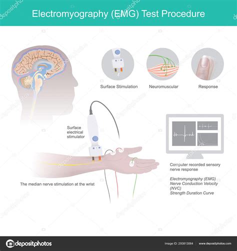 Electromyography Test Procedure Stock Vector Image By ©pattarawit