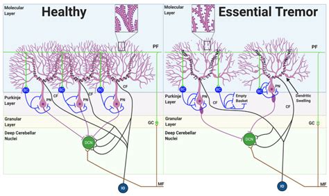 파킨슨병 손떨림과 수전증 본태성 떨림 차이점은 바로 이부분 네이버 블로그