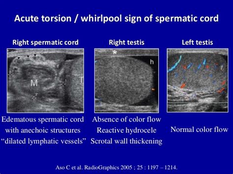 Medical Ultrasound Testicular Torsion