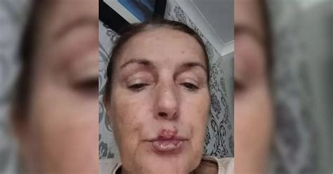 Womans Lips Swell And Scab Up After Drinking From Dirty Cup At Tui
