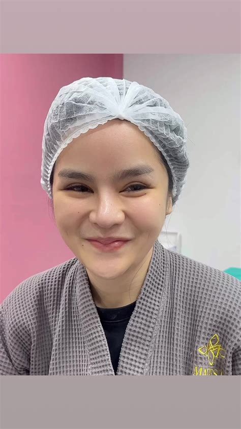 แก้ปัญหาจมูกเอียง ให้กลับมาตรงสวยเป๊ะเป็นปกติ เลาะพังผืด เปิดช่องวางใหม่ ปรับฐาน กระดูกให้เรียบ