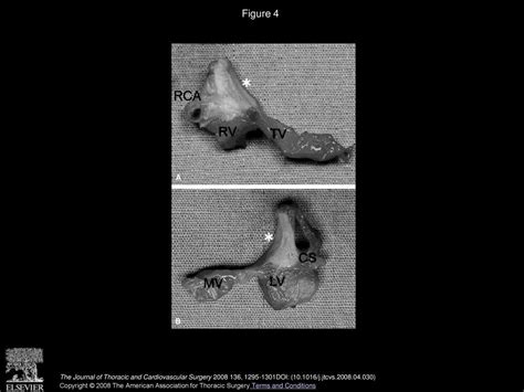 Surgical Ablation For Atrial Fibrillation The Efficacy Of A Novel Bipolar Pen Device In The