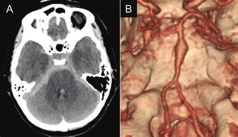 A Ct On Admission Showing Diffuse Subarachnoid Hemorrhage B 3d Cta