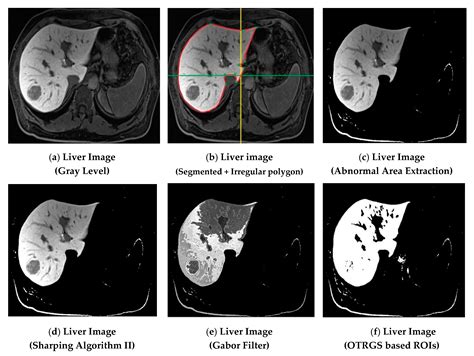 Machine Learning Based Hybrid Feature Analysis For Liver Cancer