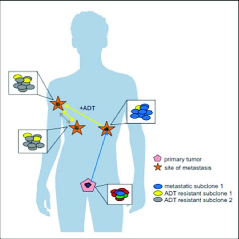 A Rare Clone In The Primary Tumor Blue Acquires Metastatic Potential
