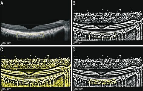 Image Binarization For Subfoveal Choroid A Original Edi Oct Image With