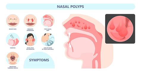 Nasal Polyps In Singapore Allergy And Sinus Ent Dr Soma